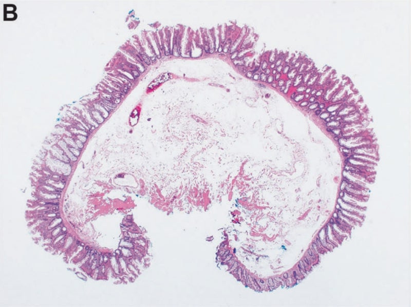 Colorectal serrated lesions and polyps, 용어 이해 ① : 네이버 블로그