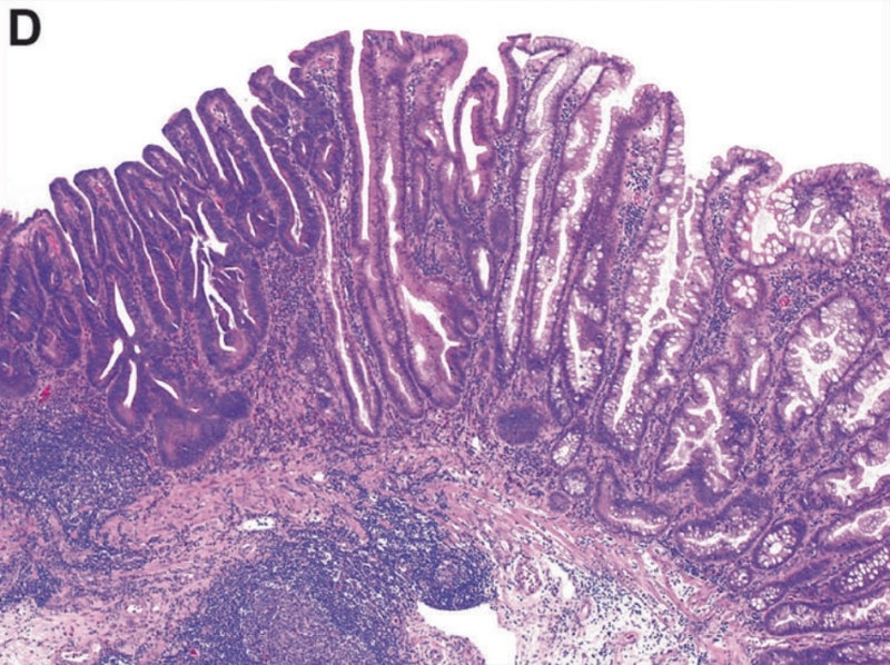 Colorectal serrated lesions and polyps, 용어 이해 ① : 네이버 블로그