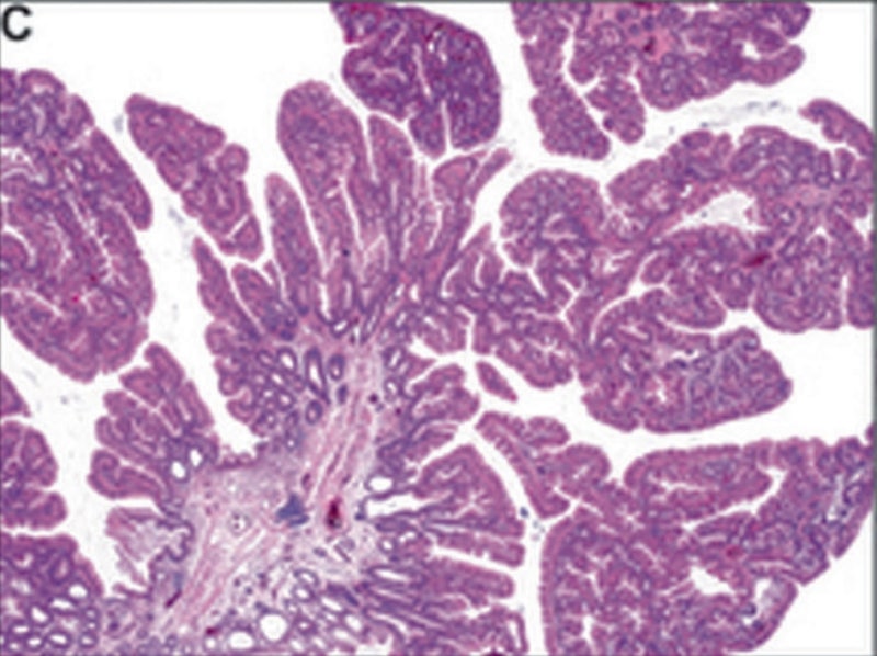 Colorectal serrated lesions and polyps, 용어 이해 ① : 네이버 블로그