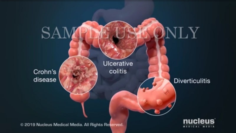 Laparoscopic exploration & Exploratory laparotomy GS hartmann op ...