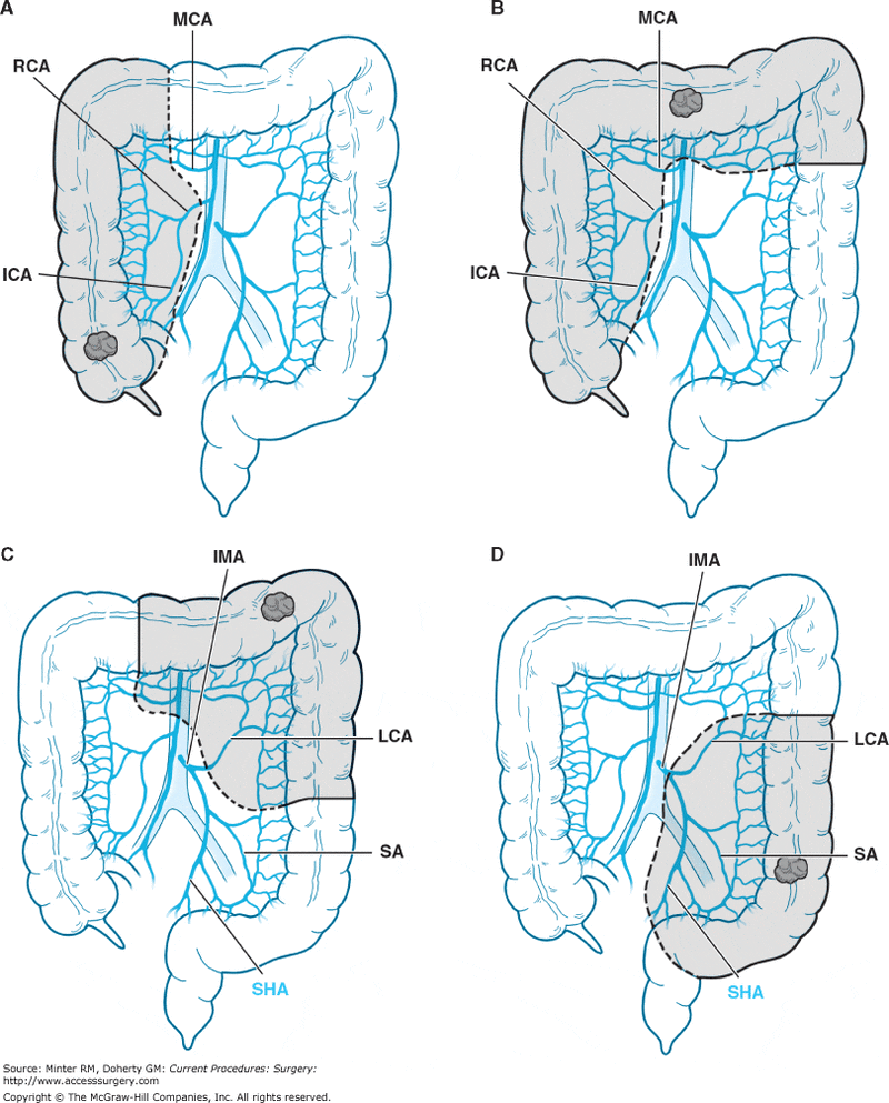 Laparoscopic exploration & Exploratory laparotomy GS hartmann op ...
