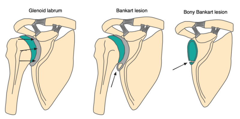 Bony bankart lesion (골성 반카르트 병변) : 네이버 블로그