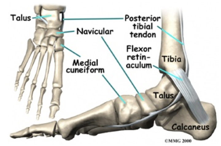 Accessory Navicular Syndrome (부주상골증후군) : 네이버 블로그