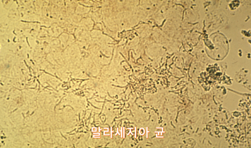 피부 어루러기 : 어루러기 치료 연고 약은? : 네이버 블로그