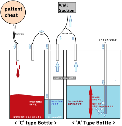 CTD : Chest Tube Drainage의 bottle 이해하기, Chest Bottle A Type-C type, CTD ...