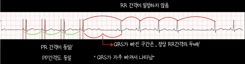 1도 2도 3도 방실차단 Av Block Ecg 네이버 블로그