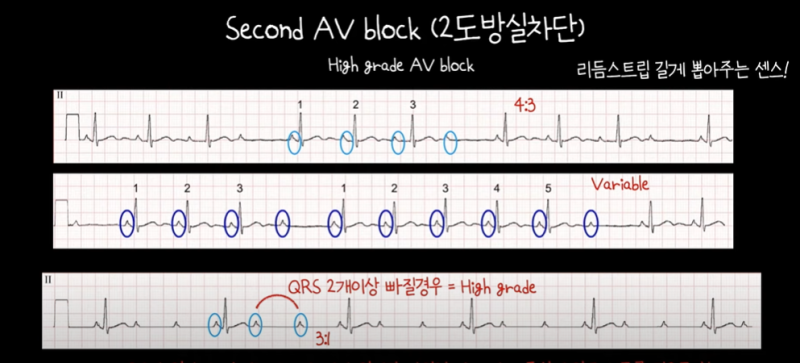1도 2도 3도 방실차단 Av Block Ecg 네이버 블로그
