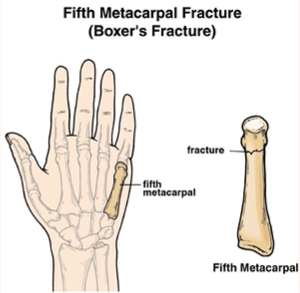 팔꿉 관절보조기(EO) : 네이버 블로그