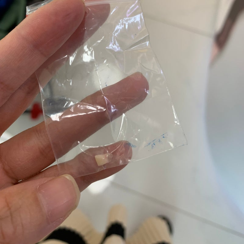 유치 빠지는 순서 영구치 나는 시기와 결손 대처 어금니 앞니 네이버 블로그
