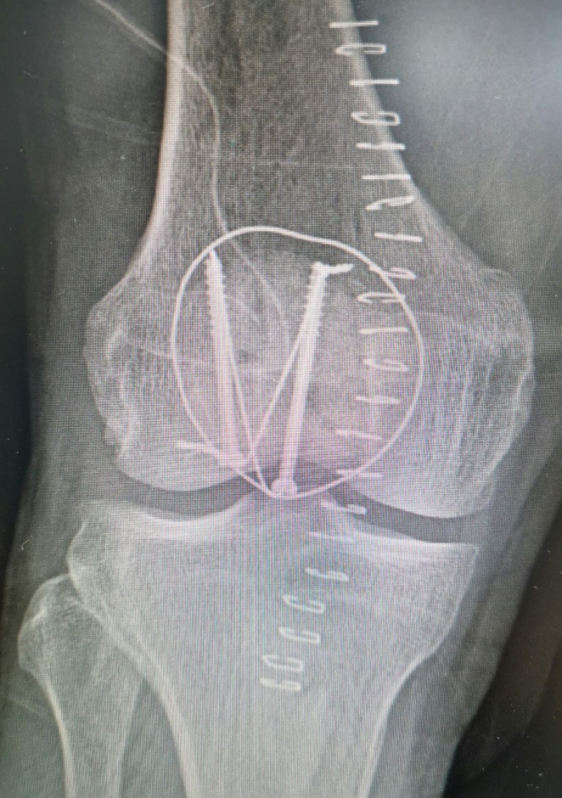 patella ORIF & Cannulated screw사용법 & TBW : 네이버 블로그