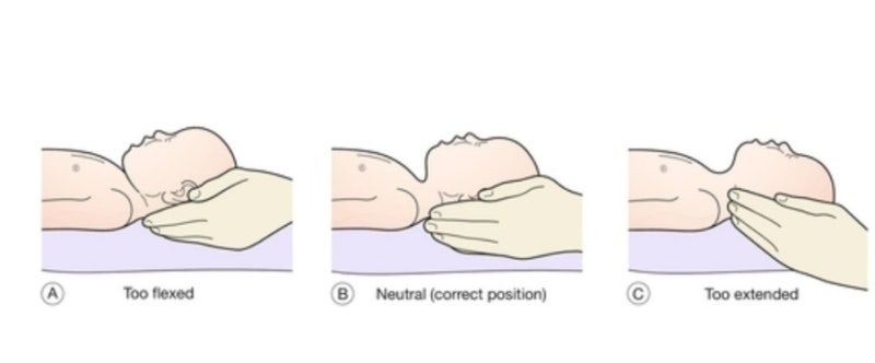 신생아 기관내 삽관 튜브(Endotracheal tube) 사이즈와 깊이, 삽관을 위한 자세(neutral sniffing ...