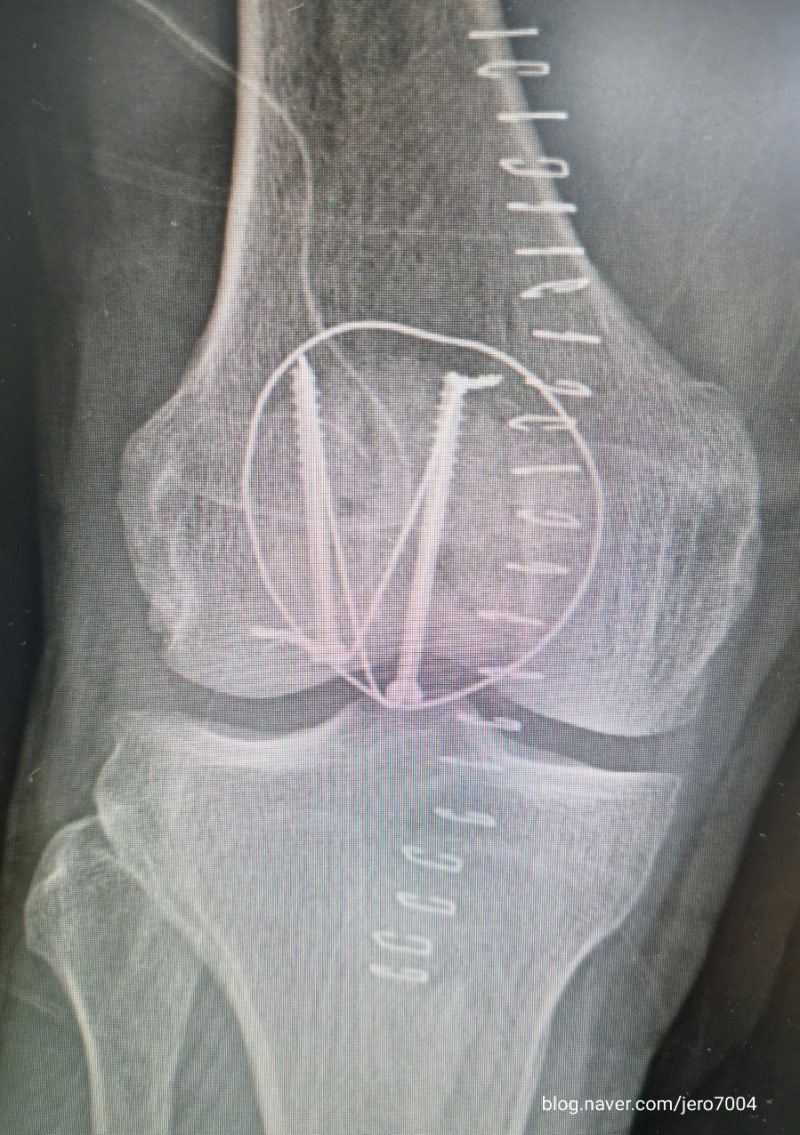 patella ORIF & Cannulated screw사용법 & TBW : 네이버 블로그