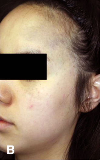 ABNOM (애브넘, 애브놈, Hori nevus, 호리 모반) 치료에도 Nd:YAG 피코 레이저가 좋다 (루비나 알렉산드라 ...