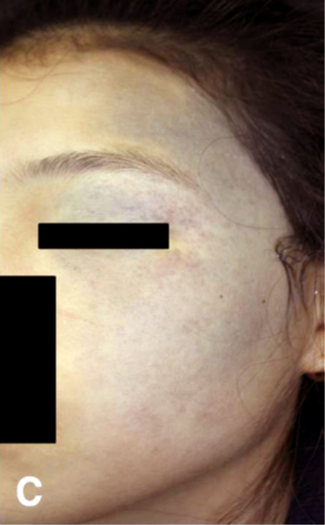 ABNOM (애브넘, 애브놈, Hori nevus, 호리 모반) 치료에도 Nd:YAG 피코 레이저가 좋다 (루비나 알렉산드라 ...