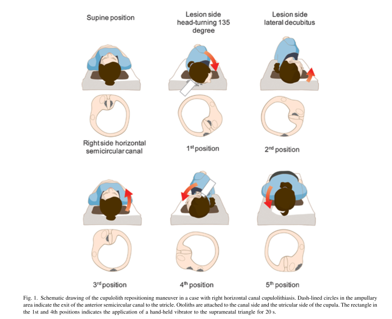 팽대부릉정에 의한 이석증 치료 (전문가용) : 네이버 블로그