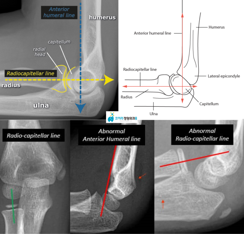 [소아 팔꿈치 골절] 낙상 이후 팔꿈치 통증을 호소하는 소아 (Posterior fad pad sign, sail sign ...