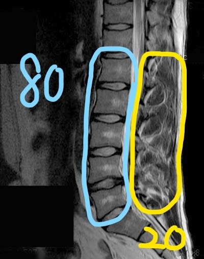 Lumbago, Backache, Sciatica[Cyriax concept] : 네이버 블로그