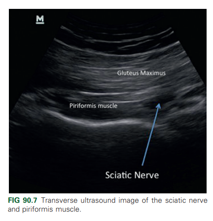 이상근 증후군(piriformis syndrome)- 엉치 부위가 많이 아프고, 다리가 저려요 (허리디스크와 비슷한 증상 ...