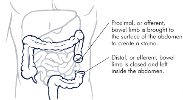 장루(stoma)의 형태에 따른 분류 - 루프형(loop), 말단형(end) 장루(ostomy) : 네이버 블로그