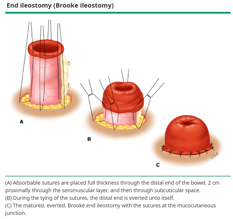 장루(stoma)의 형태에 따른 분류 - 루프형(loop), 말단형(end) 장루(ostomy) : 네이버 블로그
