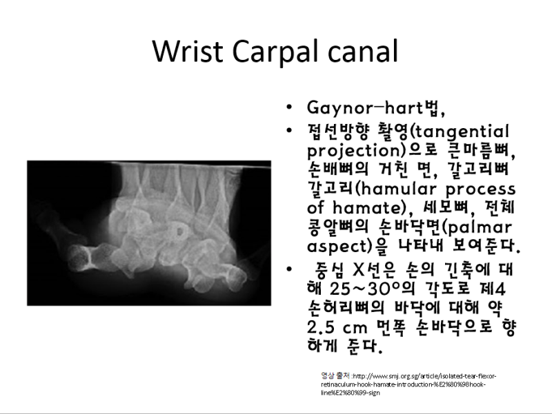 [일반촬영] 손목 손목관 촬영 (Wrist Carpal canal - Gaynor–hart) : 네이버 블로그