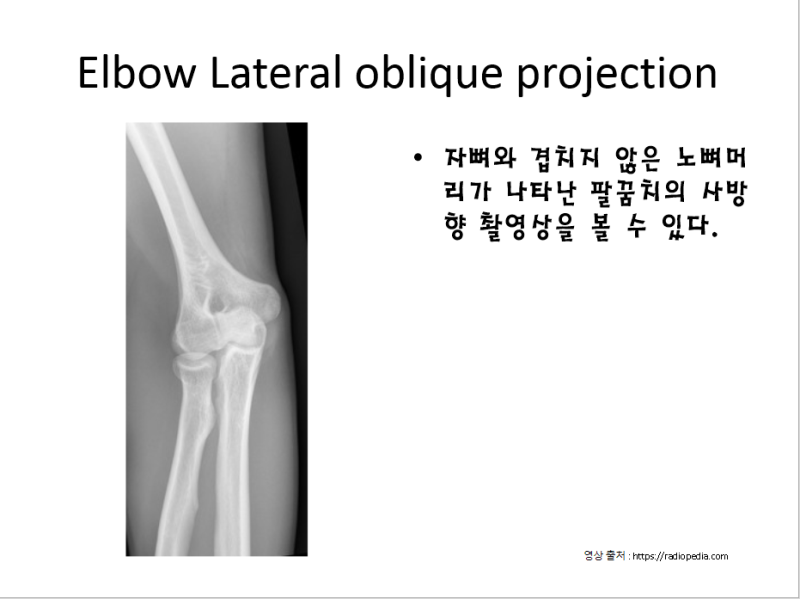 [일반촬영] 팔꿈치 가쪽 사방향 촬영 (Elbow Lateral oblique projection) : 네이버 블로그