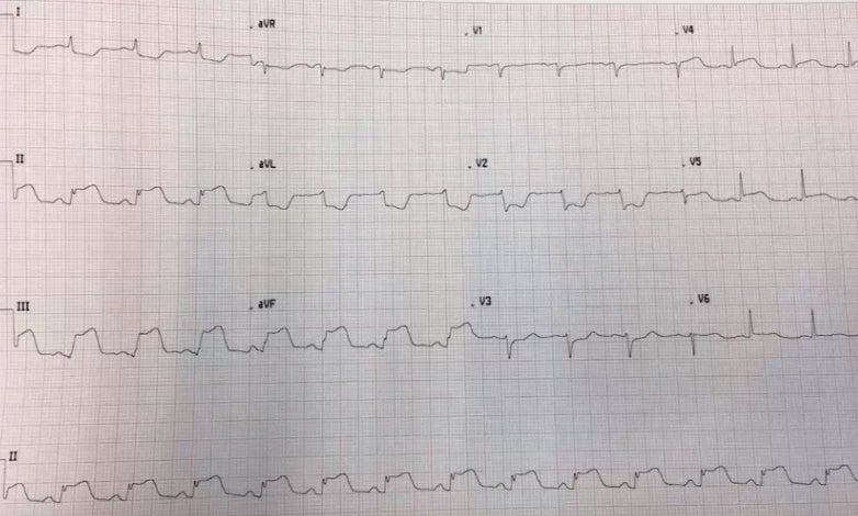 증상이 있는 환자의 심전도에서 aVL T wave inversion은 inferior STEMI의 초기 징후일 수 있습니다 ...