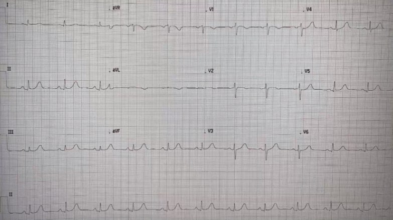 증상이 있는 환자의 심전도에서 aVL T wave inversion은 inferior STEMI의 초기 징후일 수 있습니다 ...