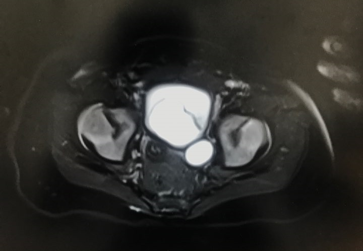 [소아비뇨의학] 중복요관 및 요관게실 (Duplex kidney Ureterocele) 환자의 진단과 치료 방향 (의뢰환자 분석 ...
