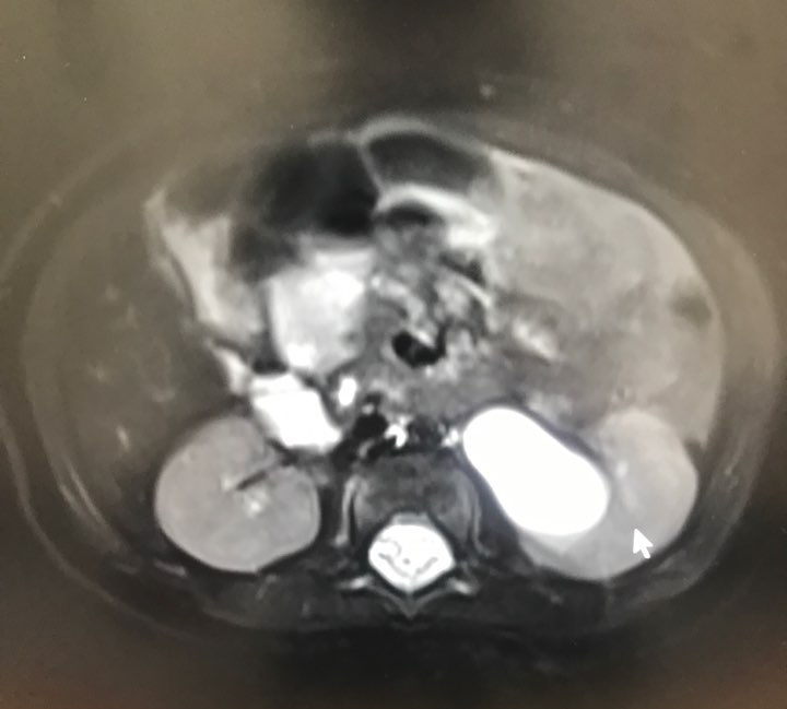 [소아비뇨의학] 중복요관 및 요관게실 (Duplex kidney Ureterocele) 환자의 진단과 치료 방향 (의뢰환자 분석 ...