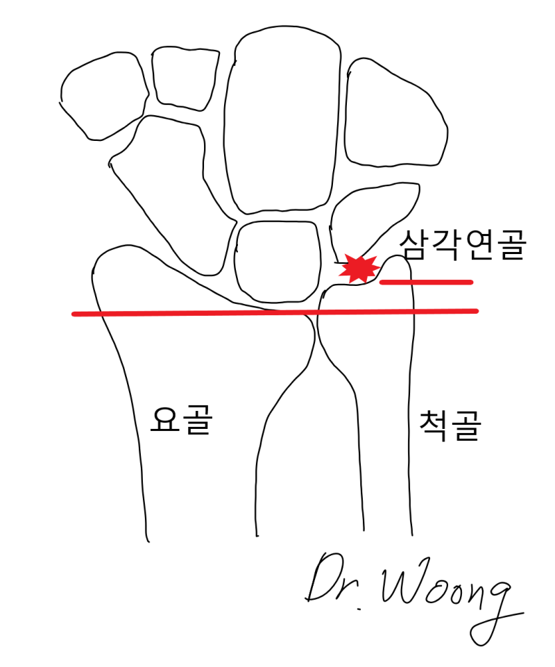 척골충돌증후군uis 척골 단축술 Uso 손목절골술 삼각연골손상 네이버 블로그