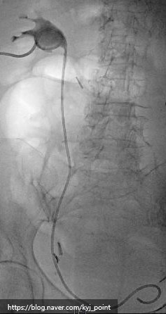 PCN(Percutaneous Nephrostomy;경피적 신루술), D-J Stent insertion(Double J ...