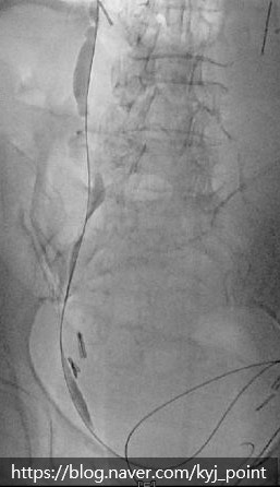 PCN(Percutaneous Nephrostomy;경피적 신루술), D-J Stent insertion(Double J ...