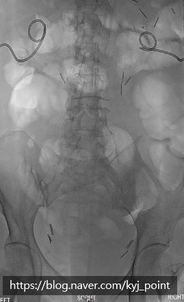 PCN(Percutaneous Nephrostomy;경피적 신루술), D-J Stent insertion(Double J ...