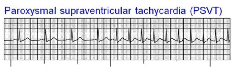 PSVT(Paroxysmal supraventricular tachycardia, 발작성 심실상성 빈맥) : 네이버 블로그