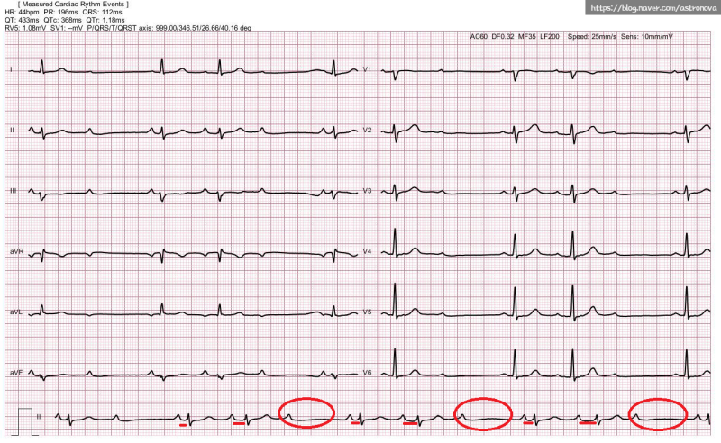 2도 방실차단 (2nd degree AV block, Mobitz type 1) : 네이버 블로그