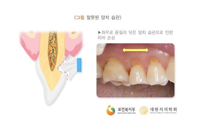 치아가 시려요 치경부마모 양산치과 유어스 네이버 블로그