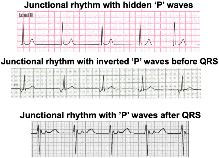 [P wave / atrial dysrhythmia ] 심방부정맥과 그에 따른 심전도의 ECG 변화/특징 : 네이버 블로그