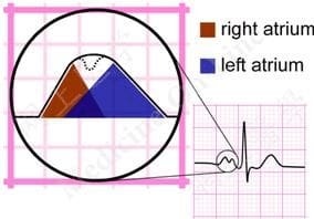 [P wave / atrial dysrhythmia ] 심방부정맥과 그에 따른 심전도의 ECG 변화/특징 : 네이버 블로그