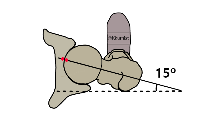 내반슬(Genu varum) O다리, 경사각(angle of inclination)과 넙다리뼈 비틀림(femoral ...