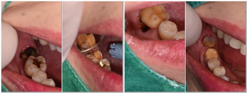 토미는 토미로 잡는다. MTA pulpotomy 치료. 발치보단 나은거 같아서 해본 지르코니아 크라운 : 네이버 블로그