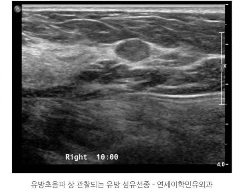 대항병원 국가건강검진 유방암 검사 음영 판정보류 재검 유방초음파검사 섬유선종 네이버 블로그