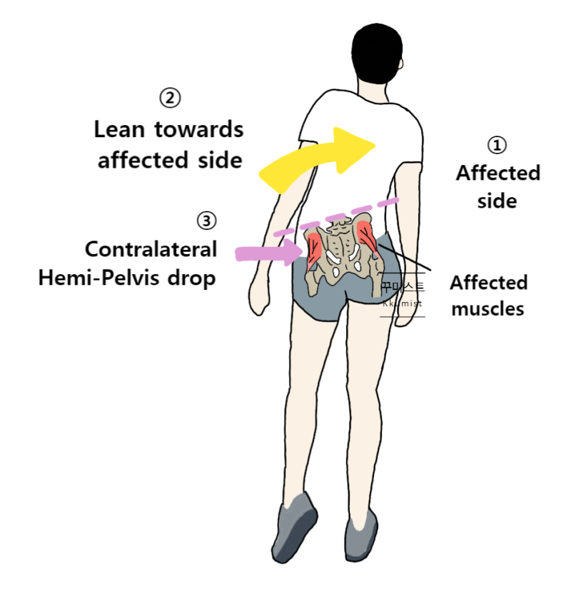 트렌델렌버그 자세 검사 Trendelenburg sign 징후 테스트 고관절 외전근(벌림근/hip abductor) 기능 ...