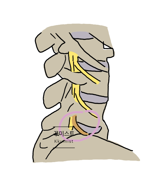 트렌델렌버그 자세 검사 Trendelenburg sign 징후 테스트 고관절 외전근(벌림근/hip abductor) 기능 ...