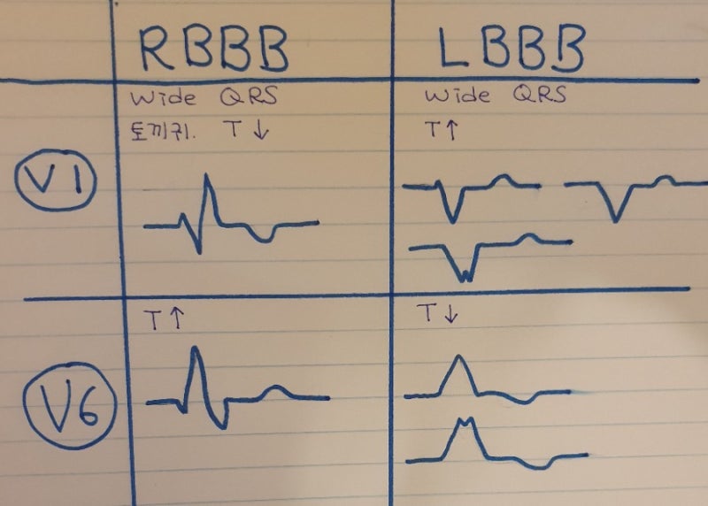 [Bundle Branch Block] RBBB, LBBB- 좌각, 우각차단- 의미와 심전도 특징 : 네이버 블로그