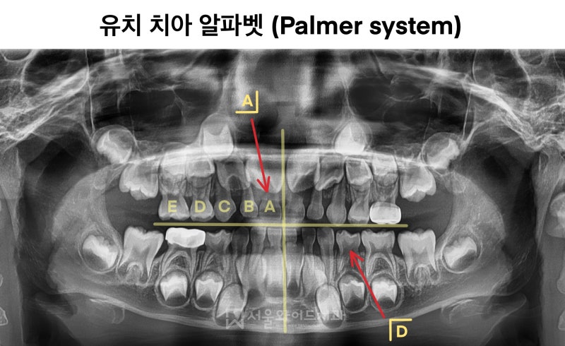 치아 번호 (영구치, 유치) - FDI, Palmer 표기법 [암사동 치과] : 네이버 블로그