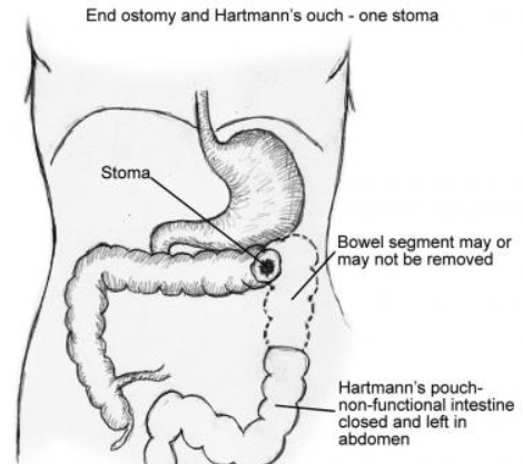 Hartmann operation, Hartmann procedure, 하트만 수술 : 네이버 블로그