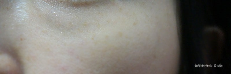 눈밑지방재배치 리얼 후기 눈밑패임 꺼짐 다크서클 없애기 네이버 블로그