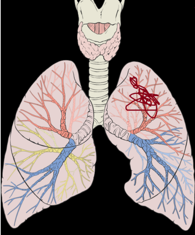 Cor Pulmonale(폐성심질환)의 이해... 정말 쉽다! : 네이버 블로그
