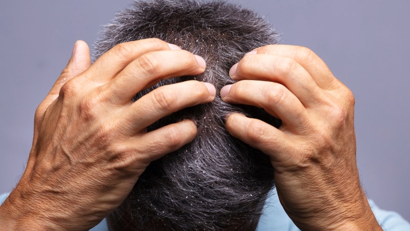 머리비듬 생기는 이유와 비듬약 종류 : 네이버 블로그